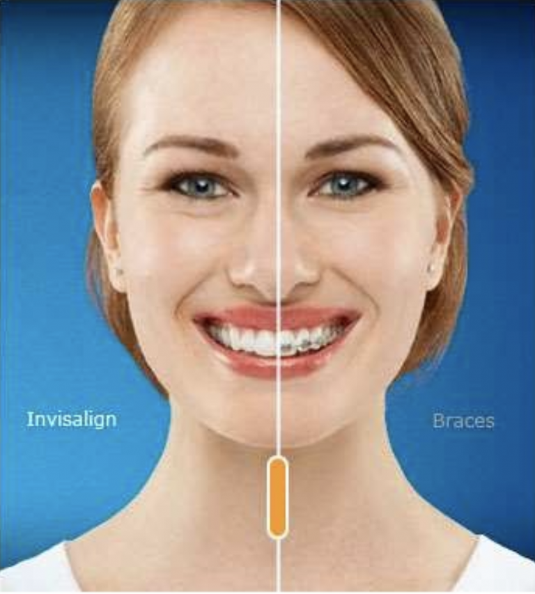 Lingual Braces vs Invisalign